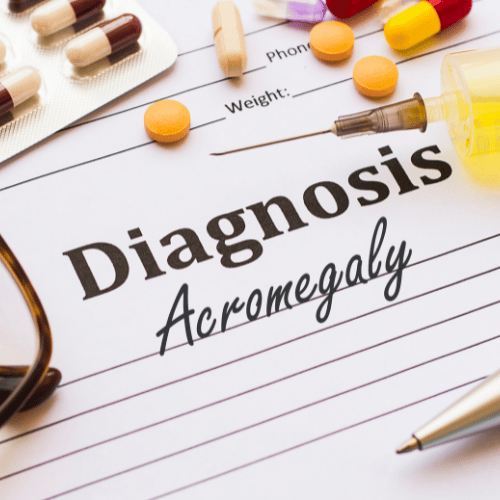 Akromegália- amikor túl sok a növekedési hormon
